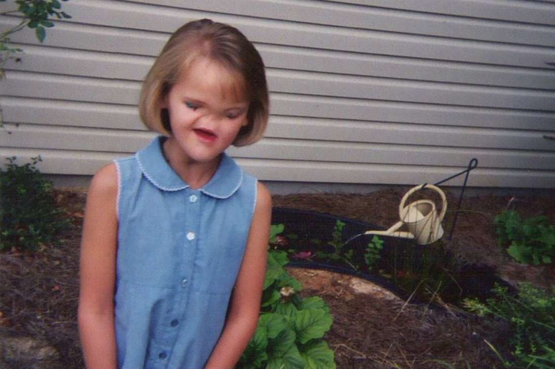 Cassidy Hooper, la niña que nació sin nariz ni ojos | EL ESPECTADOR