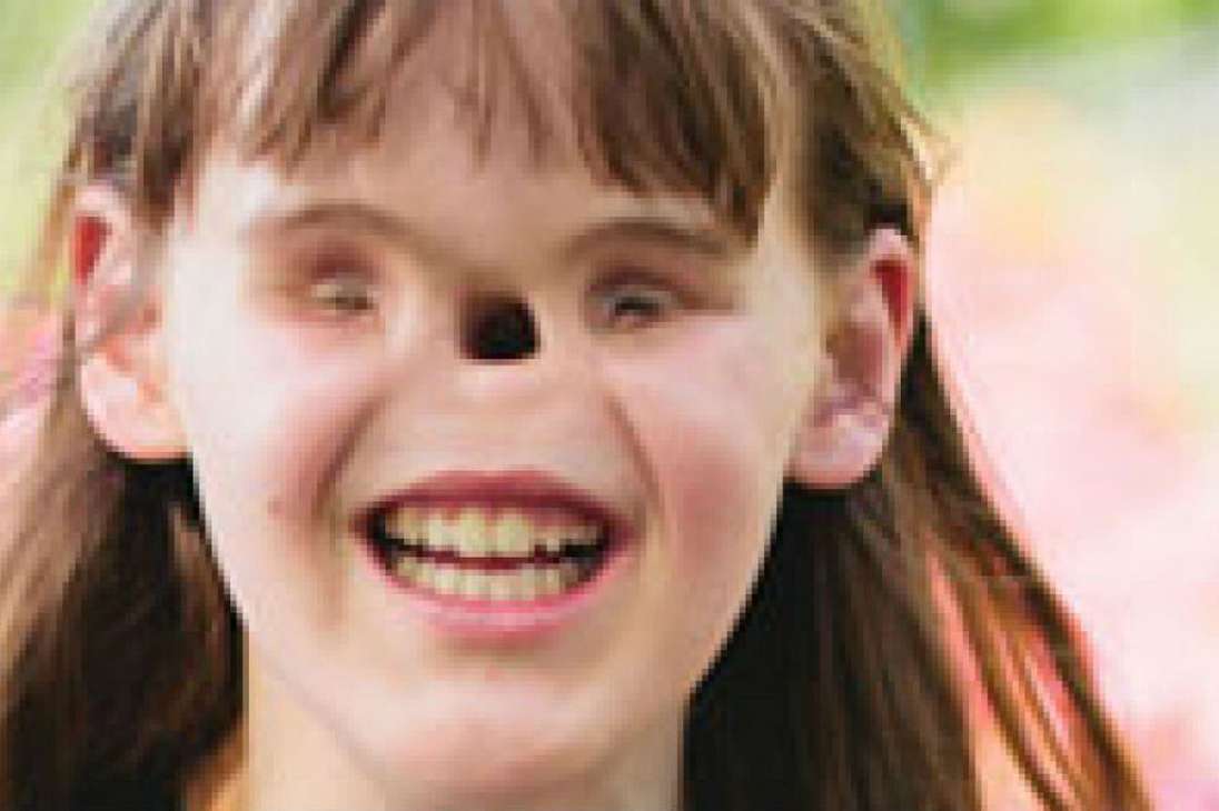 Cassidy Hooper, la niña que nació sin nariz ni ojos | EL ESPECTADOR