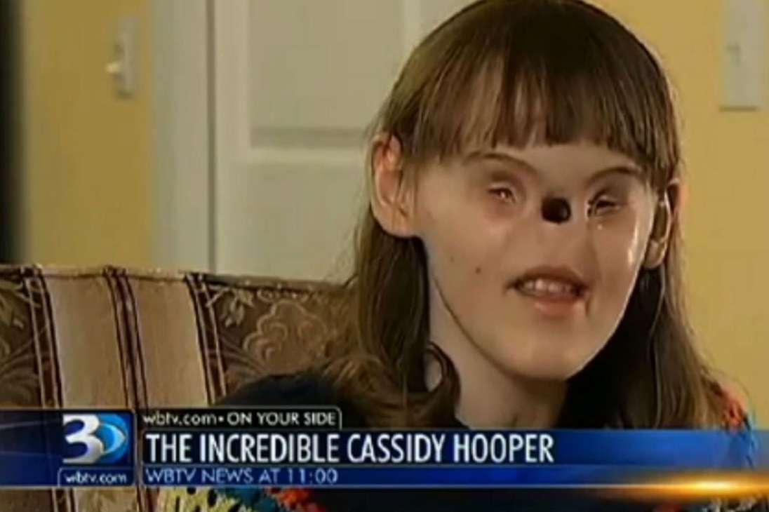 Cassidy Hooper, la niña que nació sin nariz ni ojos | EL ESPECTADOR